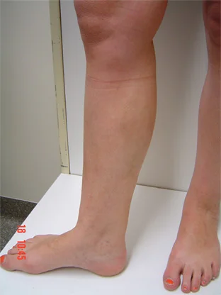 Post Sclerotherapy Pigmentation | Vein Health
