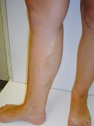 Post Sclerotherapy Pigmentation | Vein Health
