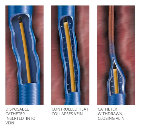 Radiofrequency Ablation - Varicose Vein Treatment