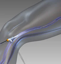 Radiofrequency Ablation - Varicose Vein Treatment