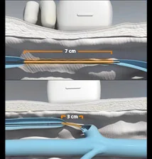 Radiofrequency Ablation - Varicose Vein Treatment