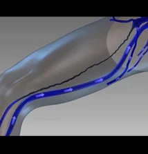 Radiofrequency Ablation - Varicose Vein Treatment