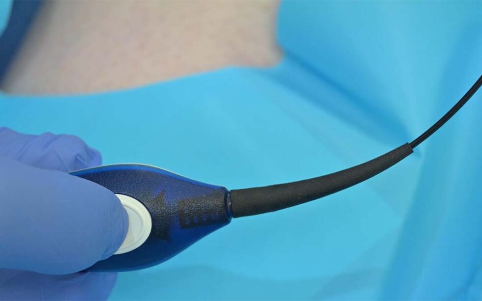 Radiofrequency Ablation: Minimally Invasive Treatment for Major Veins ... Radiofrequency Ablation: Minimally Invasive Treatment for Major Veins ...