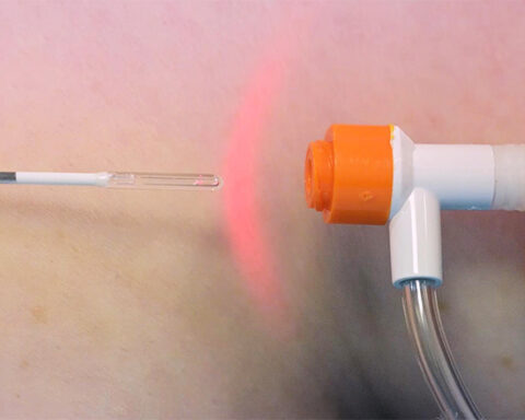 Endovenous Laser Ablation (EVLA) - Varicose Vein Treatment