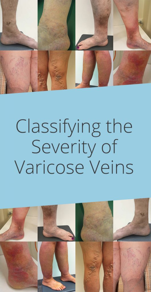 How we classify Venous Disease - Vein Health Melbourne