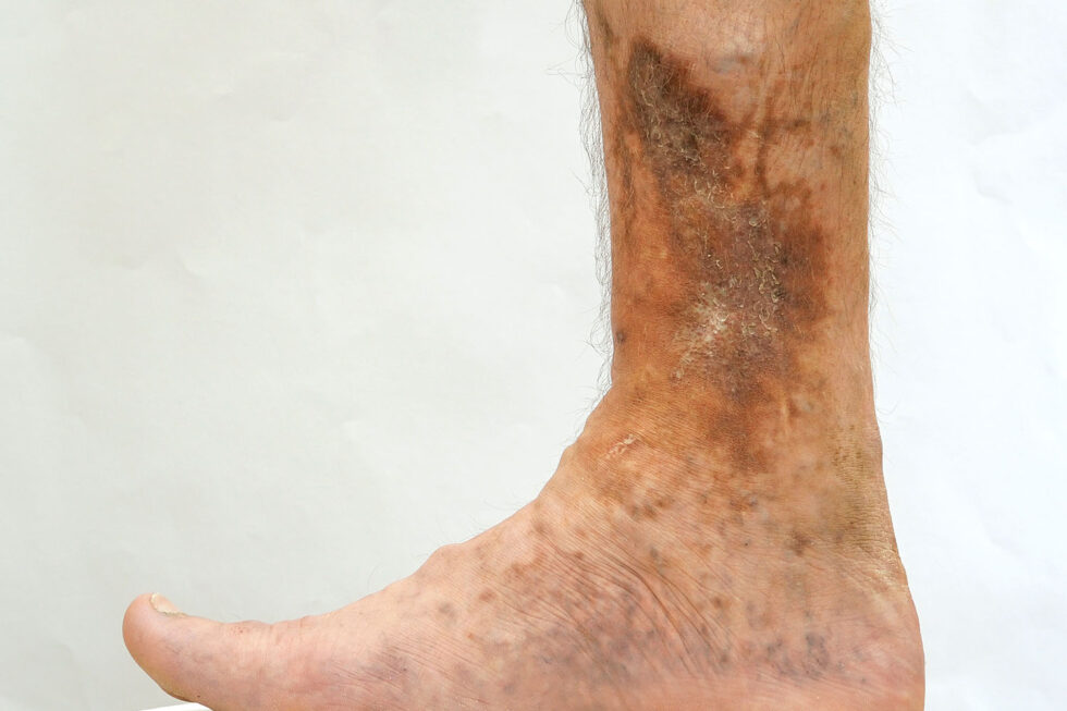 Why are venous leg ulcers so hard to heal? Causes and Effective Solutions