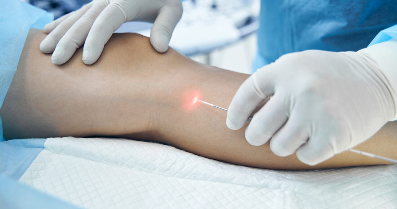 Tumescent Anaesthesia for Varicose Veins: Precision and Comfort